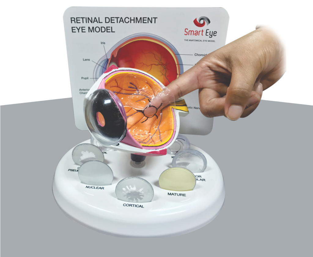 Retinal Detachment Eye Model – MSA Ophthalmic Group